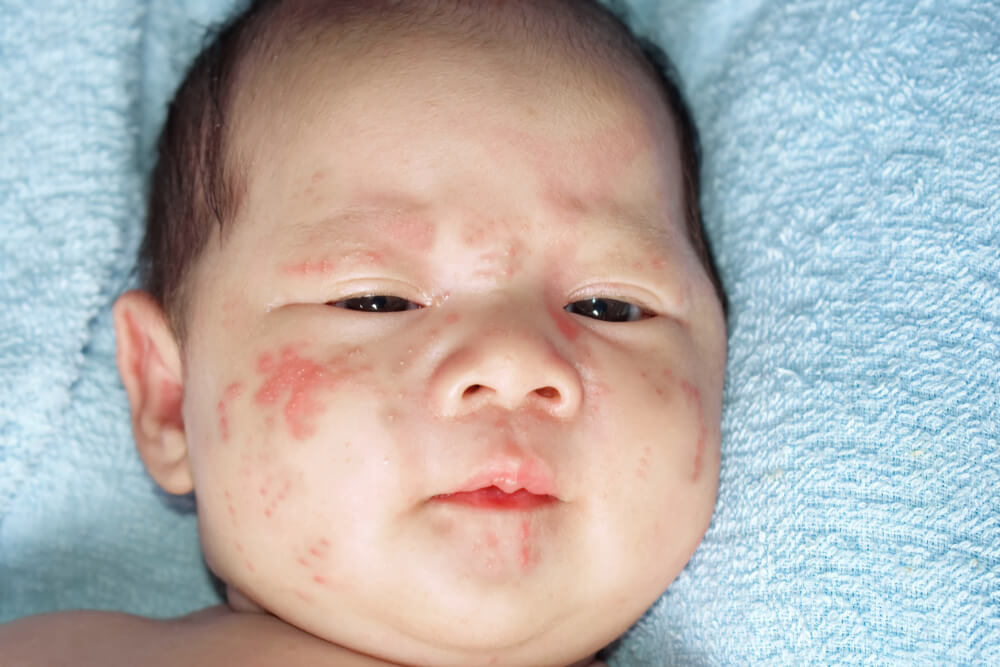 Skin Color and Texture - Birth Disorders